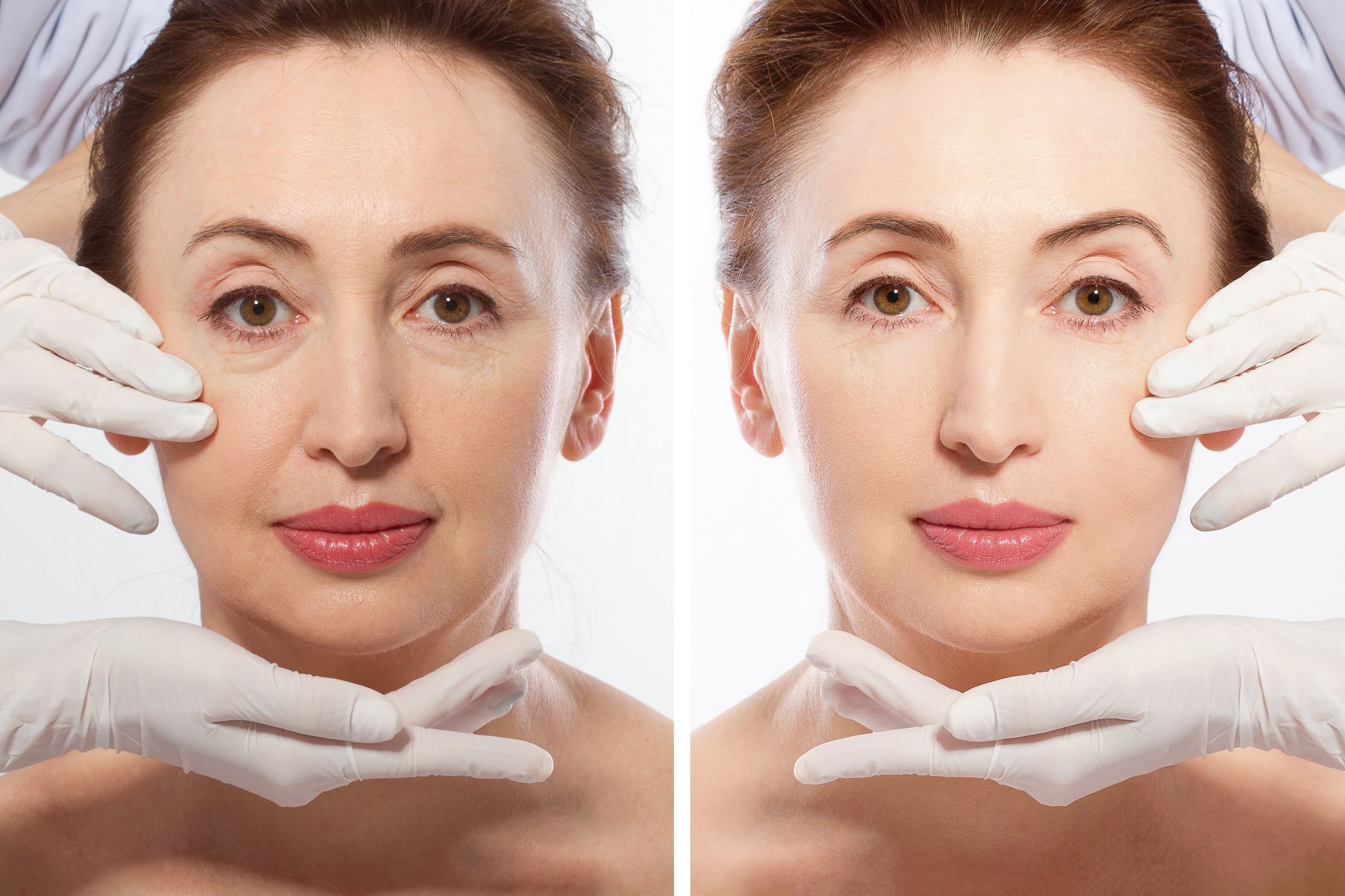 The Difference Between PDO Smooth Threads and Traditional Facelifts | Crystal Clear Dental Spa ...